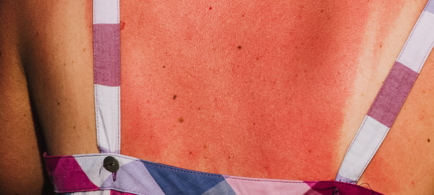 Verbrand? Dit kunt u ertegen doen - MAX Vandaag