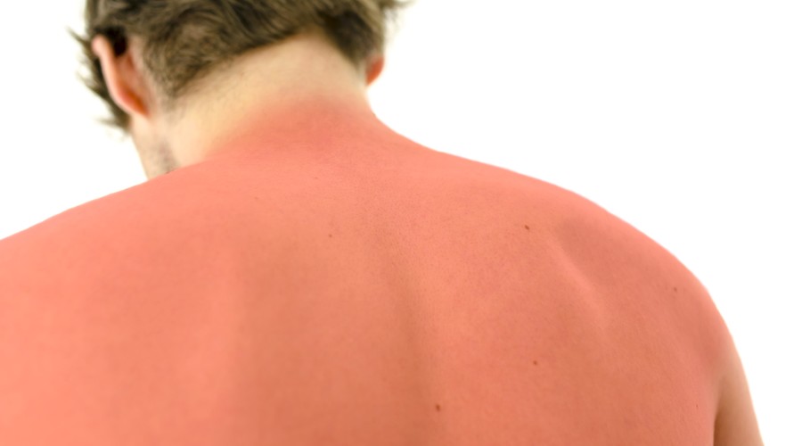 Hoe zit het? Is 1 keer verbranden al gevaarlijk? - MAX Vandaag