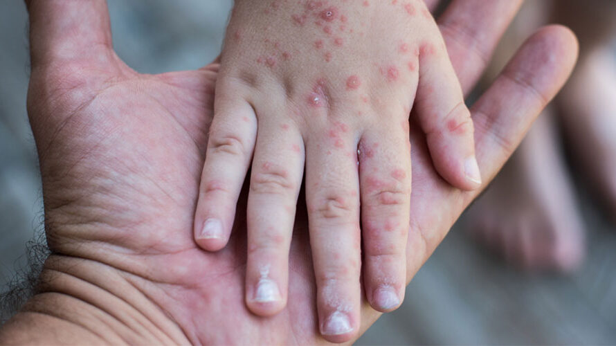 Ted van Essen: een vaccinatie tegen mazelen doe je niet alleen voor ...